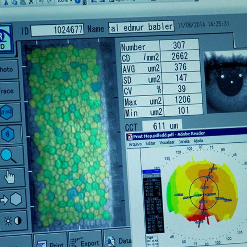 Microscopia especular de córnea - Visão Hospital Oftalmológico